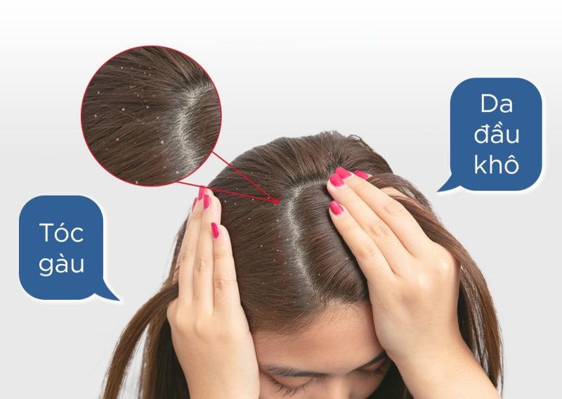 Da đầu gàu điều trị như thế nào để chúng không còn xuất hiện?